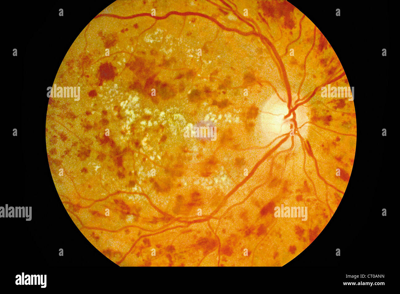 DIABETIC RETINOPATHY Stock Photo - Alamy DIABETIC RETINOPATHY Stock Photo - Alamy