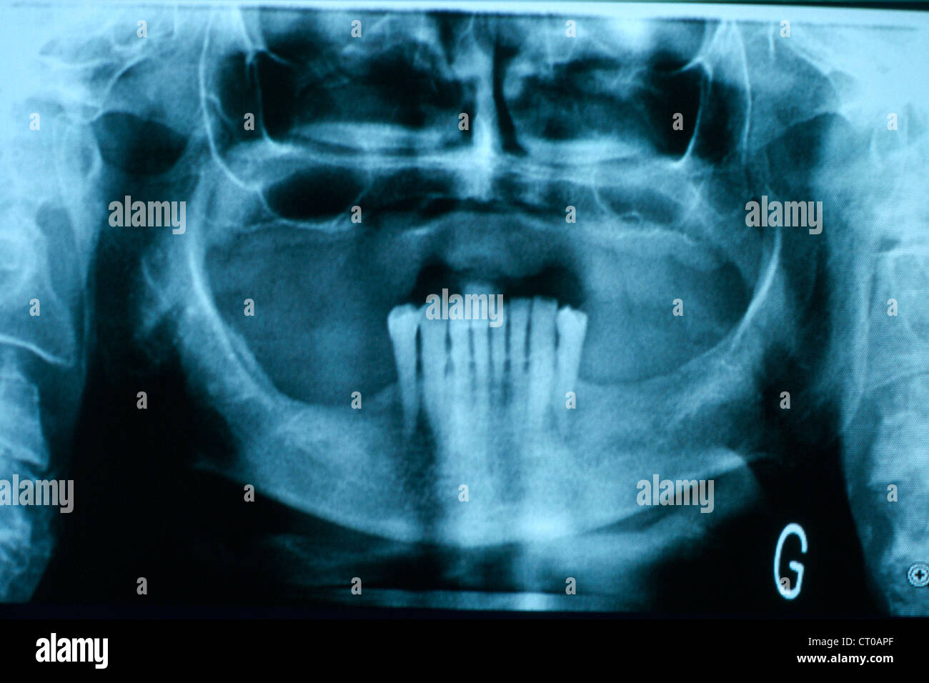 Xray investigation hi-res stock photography and images - Alamy