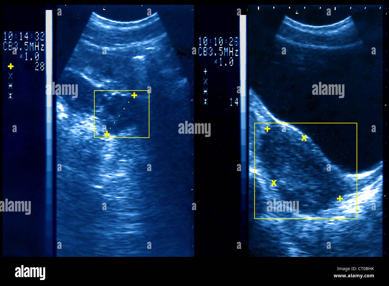 Ovaries scan hi-res stock photography and images - Alamy