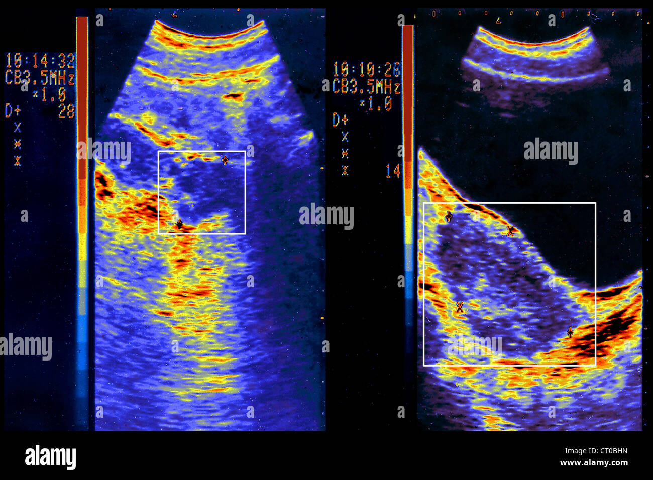 Ovaries scan hi-res stock photography and images - Alamy