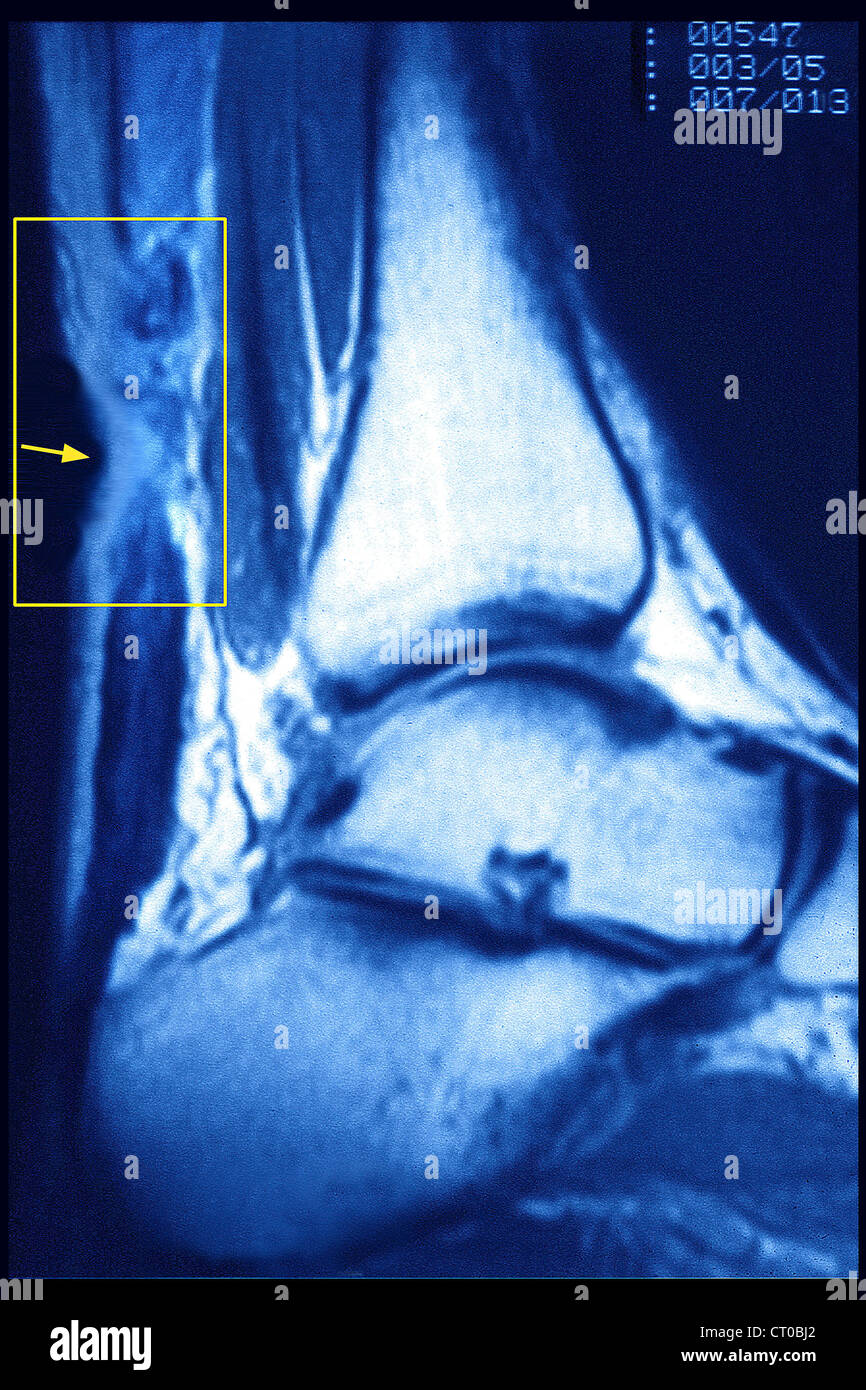 SPRAINED ANKLE, MRI Stock Photo - Alamy
