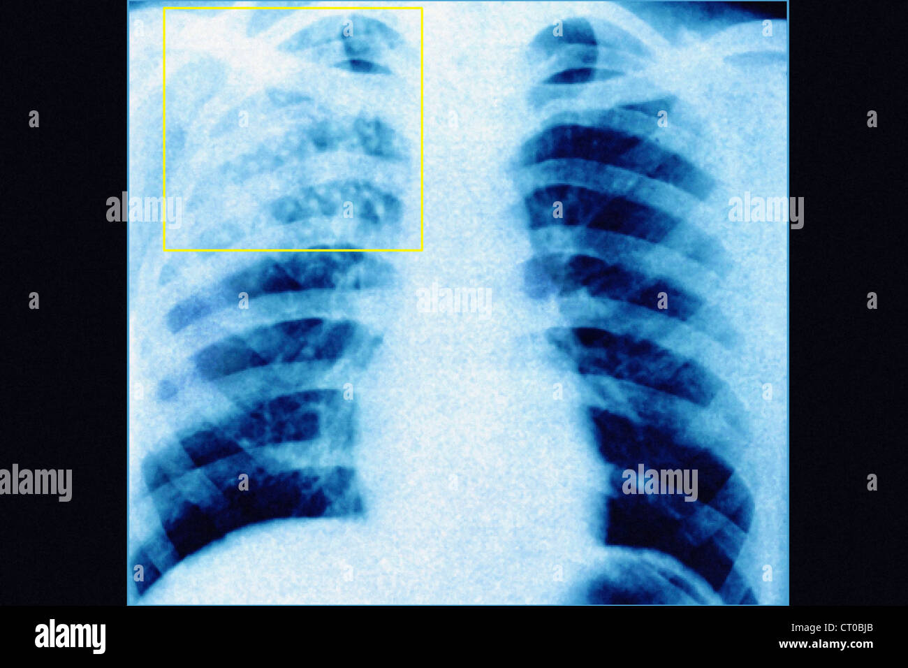 X ray tuberculosis hi-res stock photography and images - Alamy