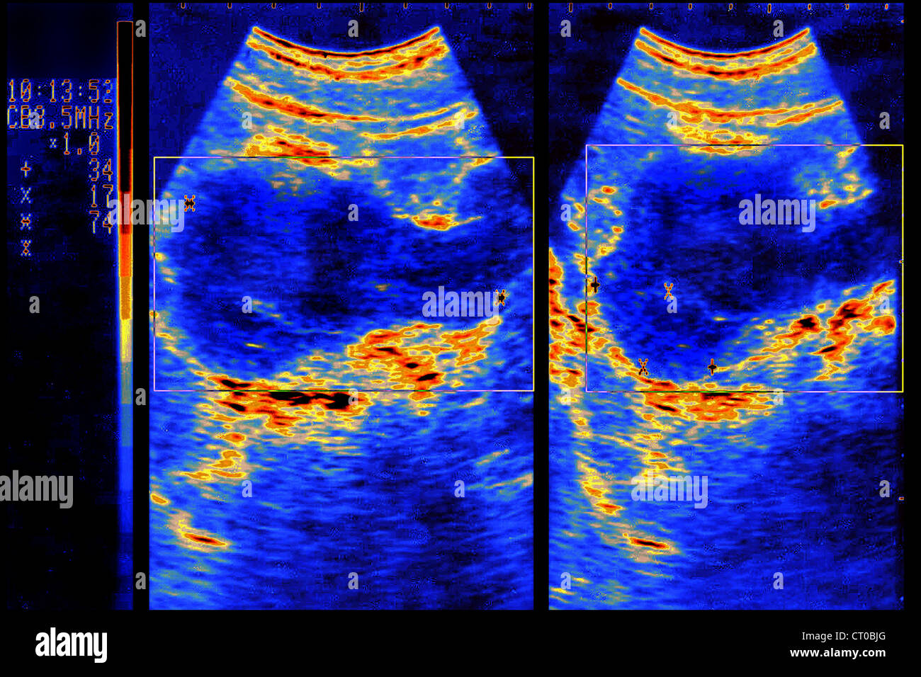 Normal uterine ultrasound hi-res stock photography and images - Alamy