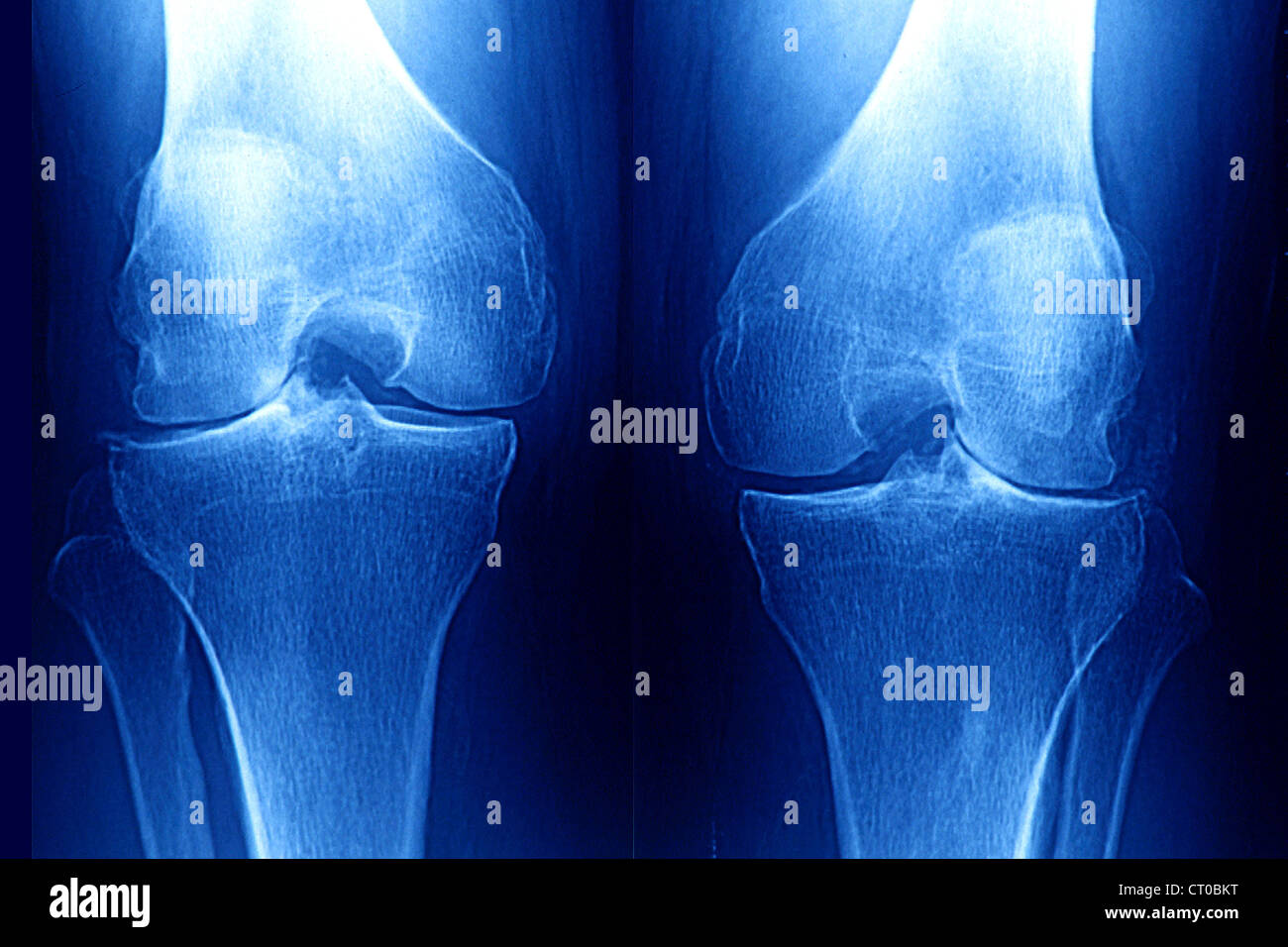 Xray Knee Osteoarthritis