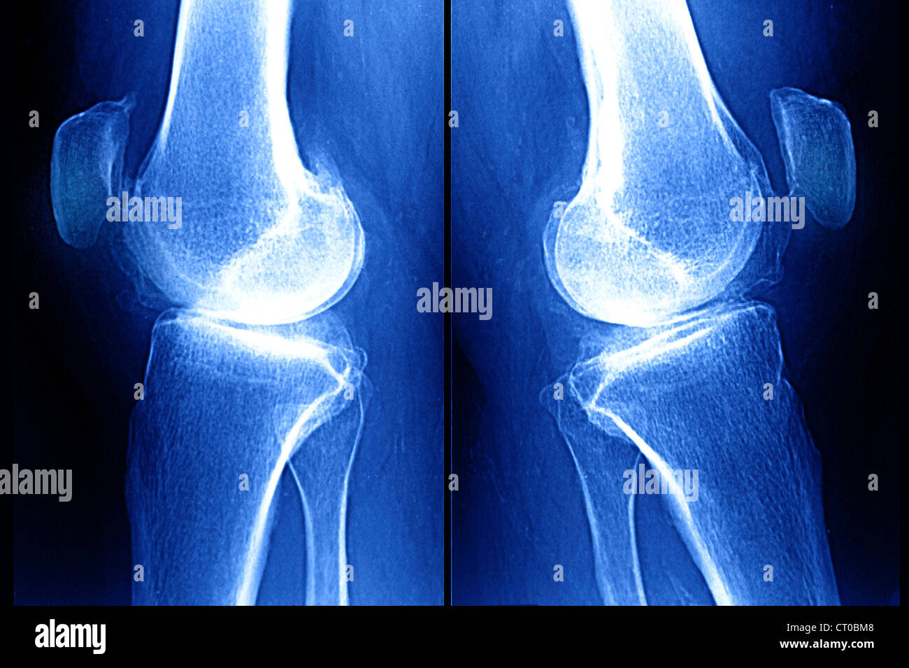 KNEE OSTEOARTHRITIS, X-RAY Stock Photo - Alamy