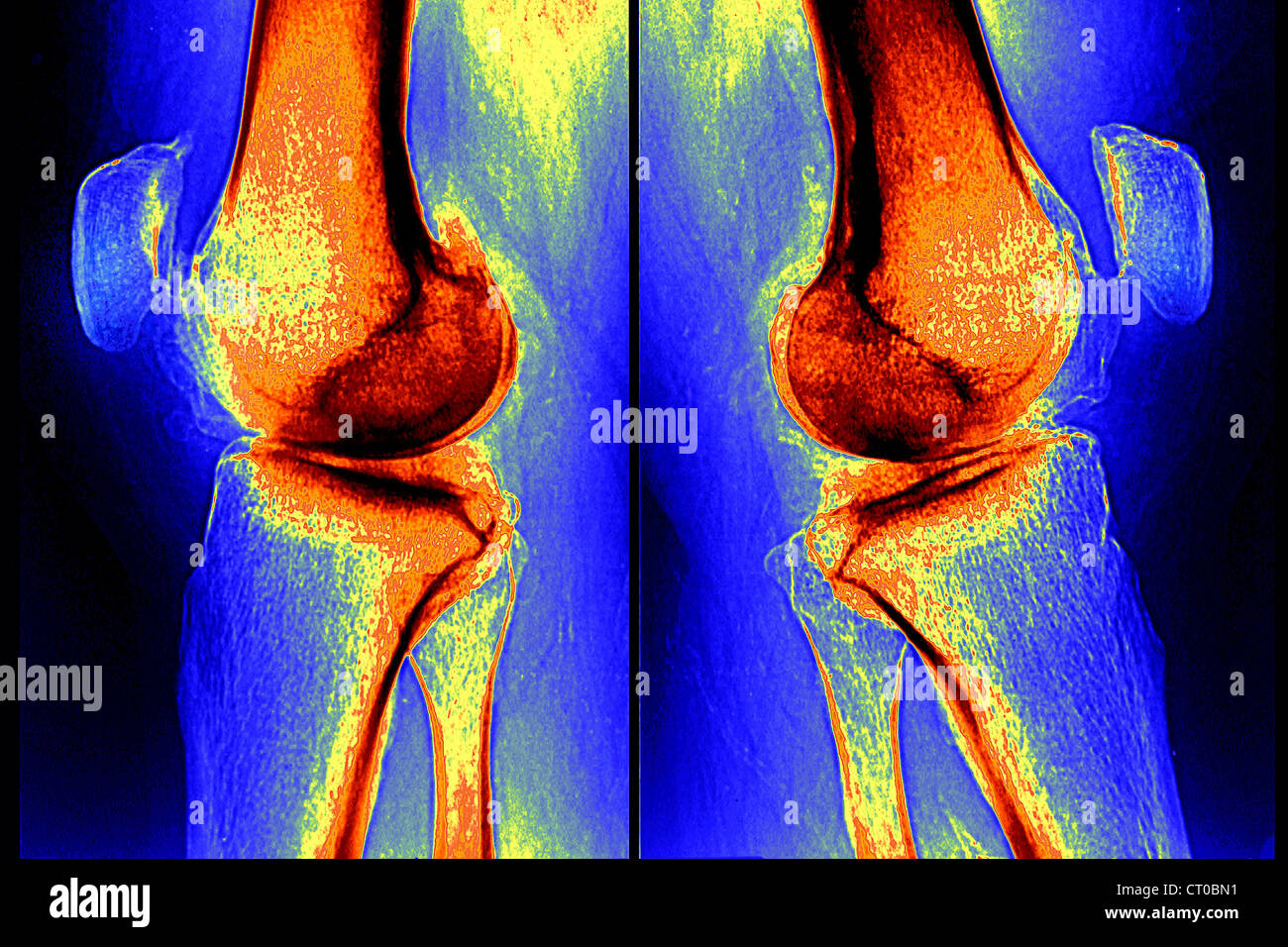 Knee Osteoarthritis X Ray High Resolution Stock Photography and Images ...