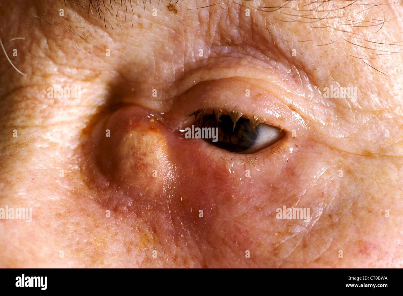 Dacryocystitis hi-res stock photography and images - Alamy