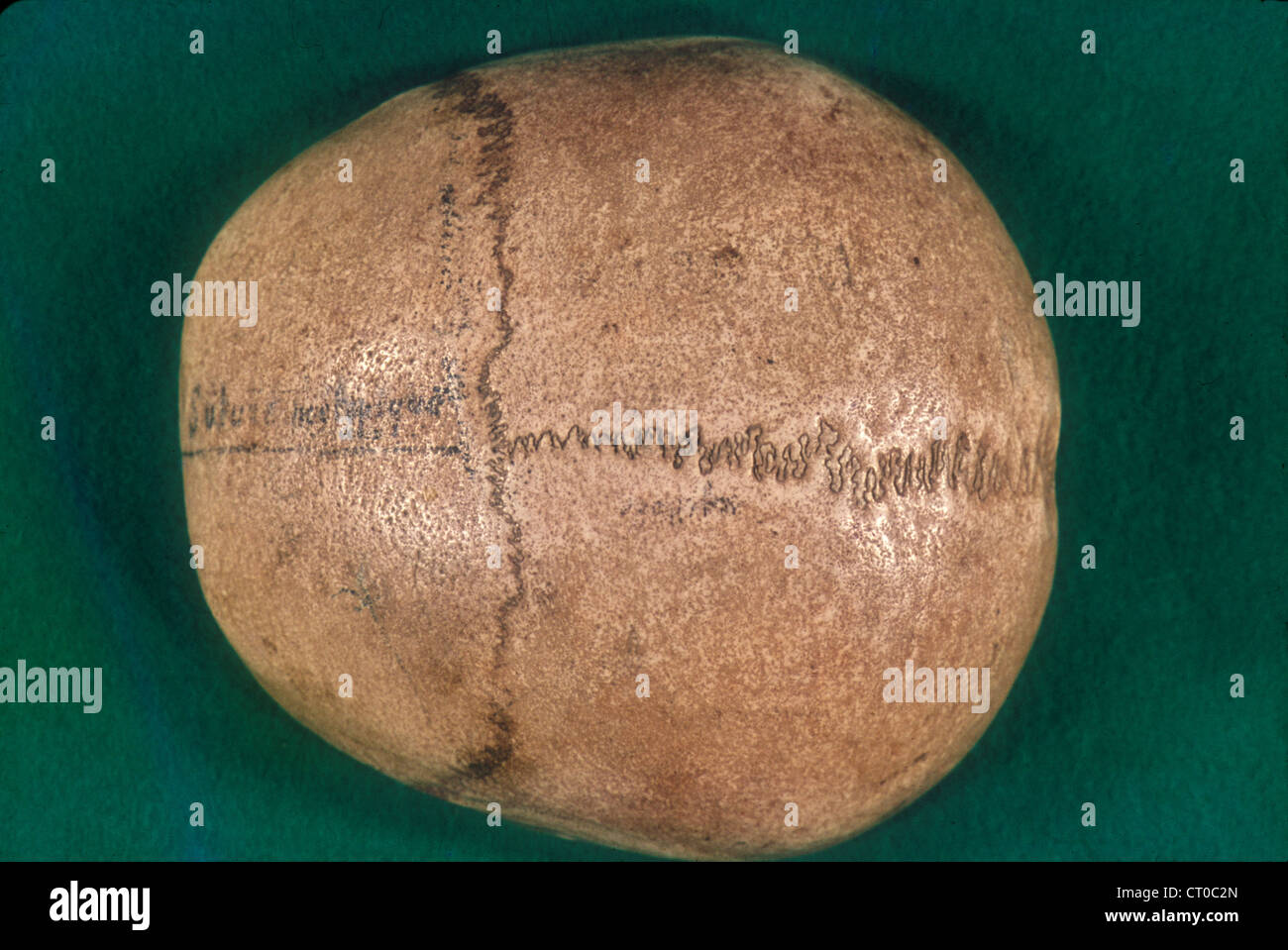 Calvarium with sutures hi-res stock photography and images - Alamy