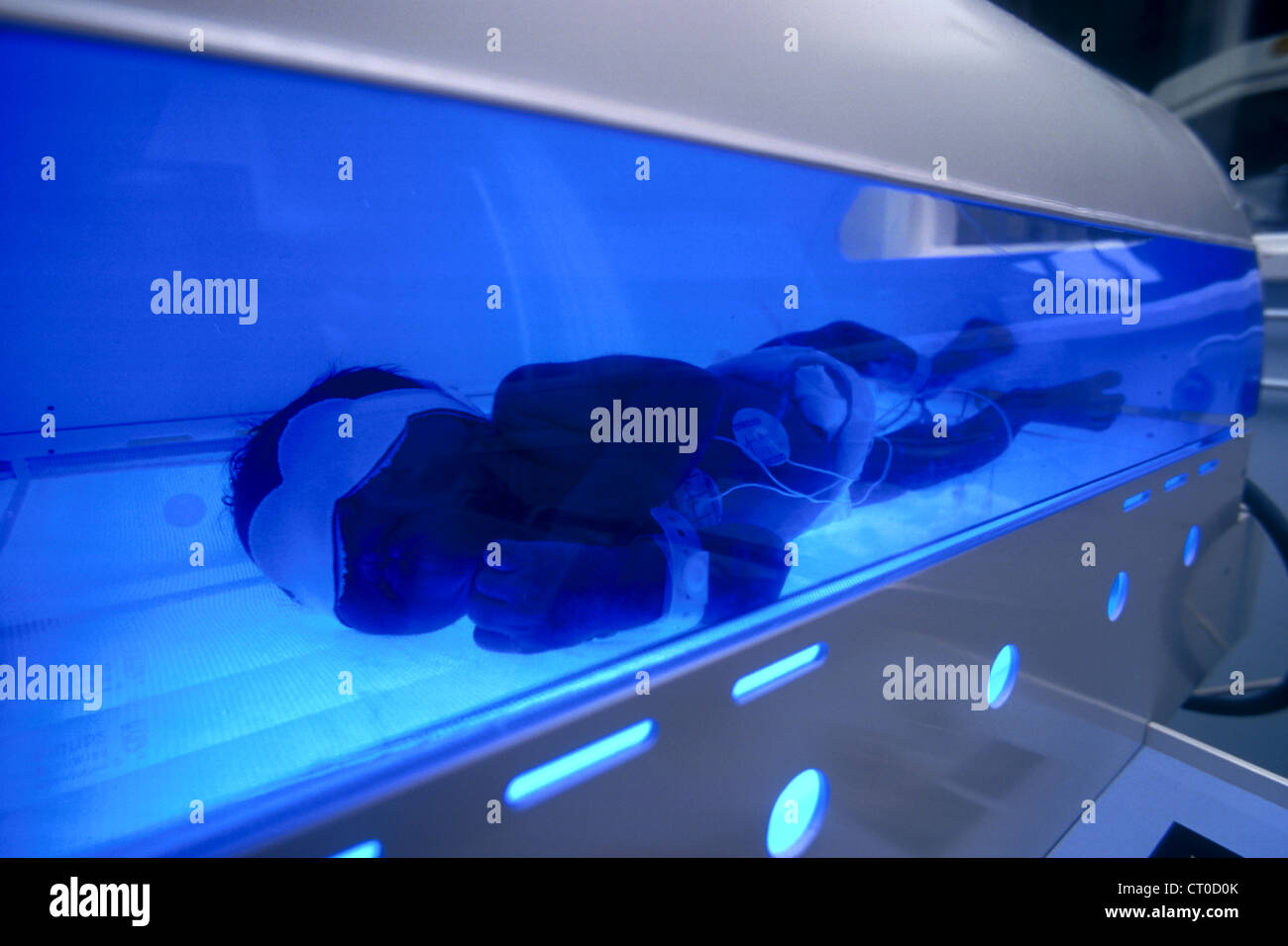 NEONATAL JAUNDICE, PHOTOTHERAPY Stock Photo - Alamy