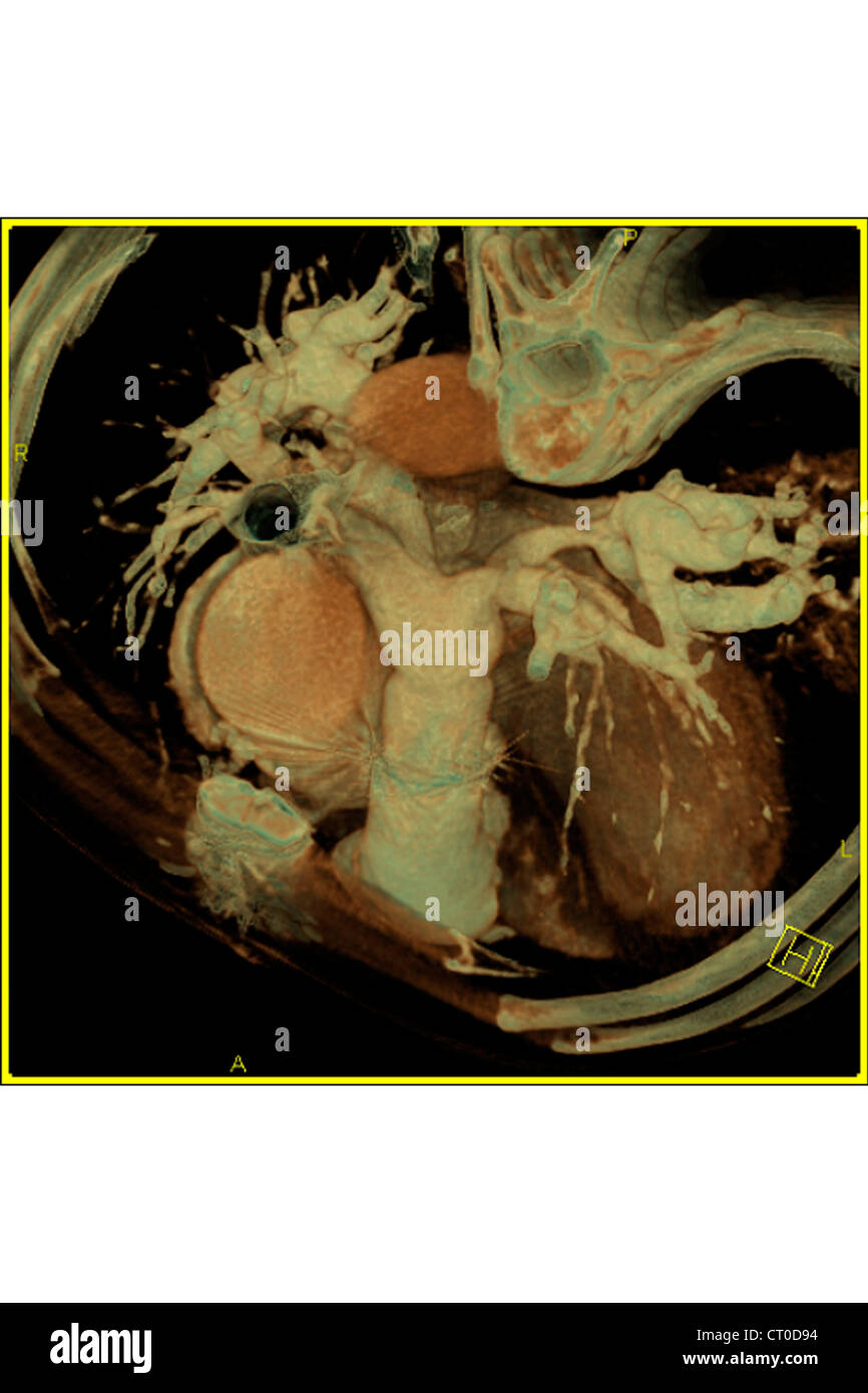 Blood vessel prosthesis hi-res stock photography and images - Alamy