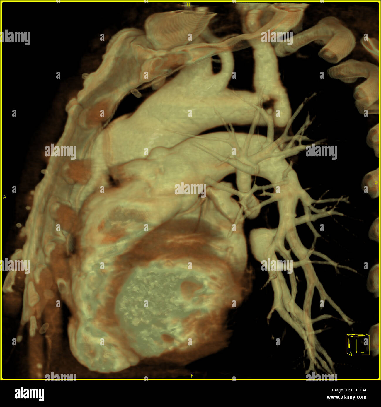 PULMONARY ARTERY, SCAN Stock Photo - Alamy