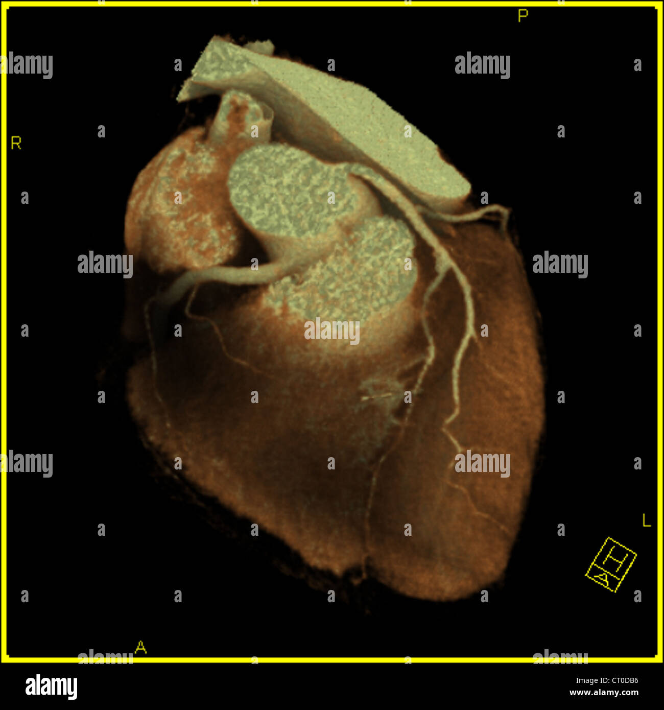 Coronary trunks hi-res stock photography and images - Alamy