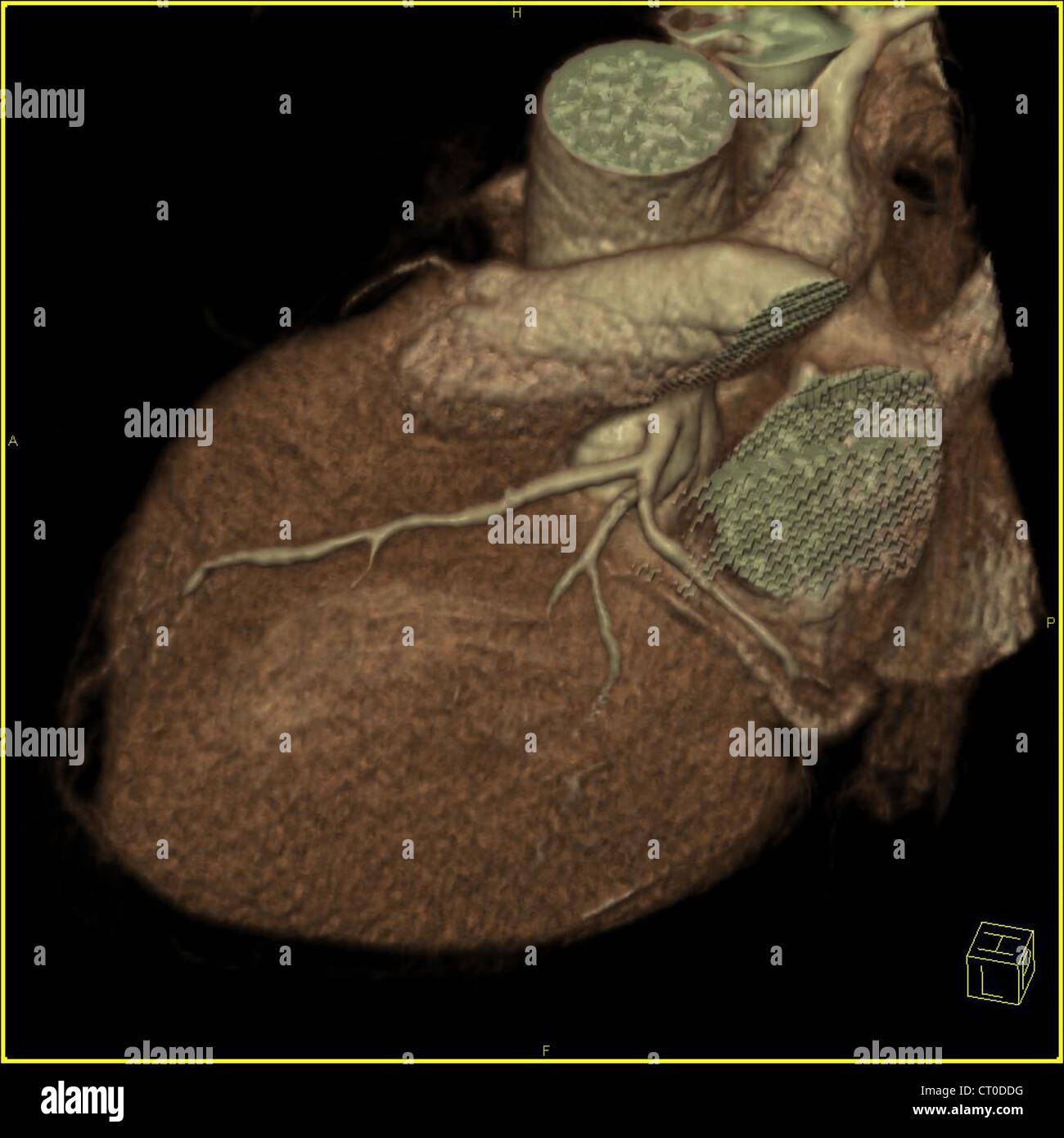 Heart blood vessels scan hi-res stock photography and images - Alamy