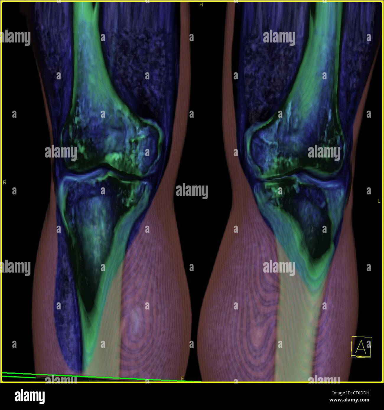 Bone scan knees hi-res stock photography and images - Alamy