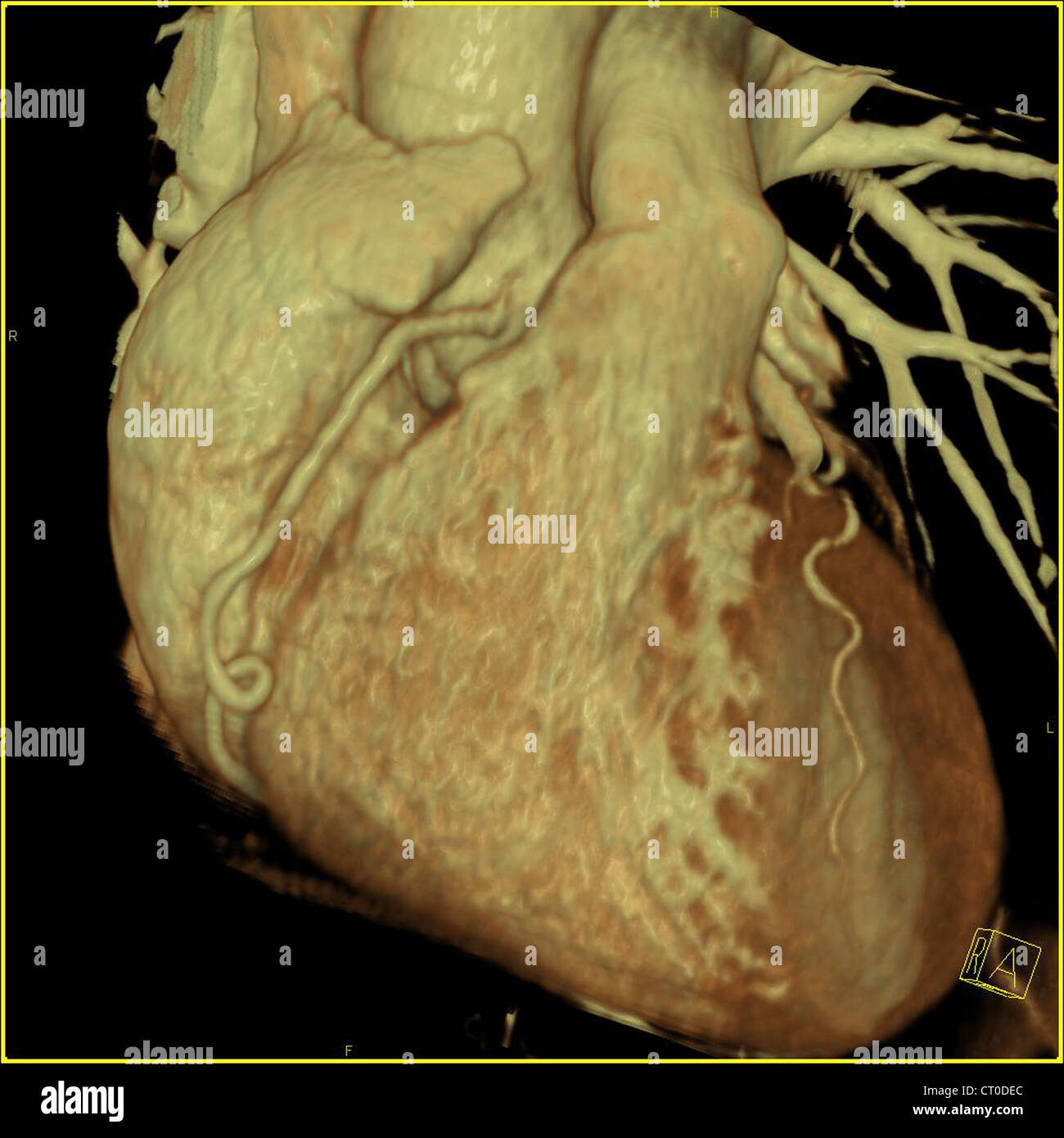 Heart blood vessels scan hi-res stock photography and images - Alamy