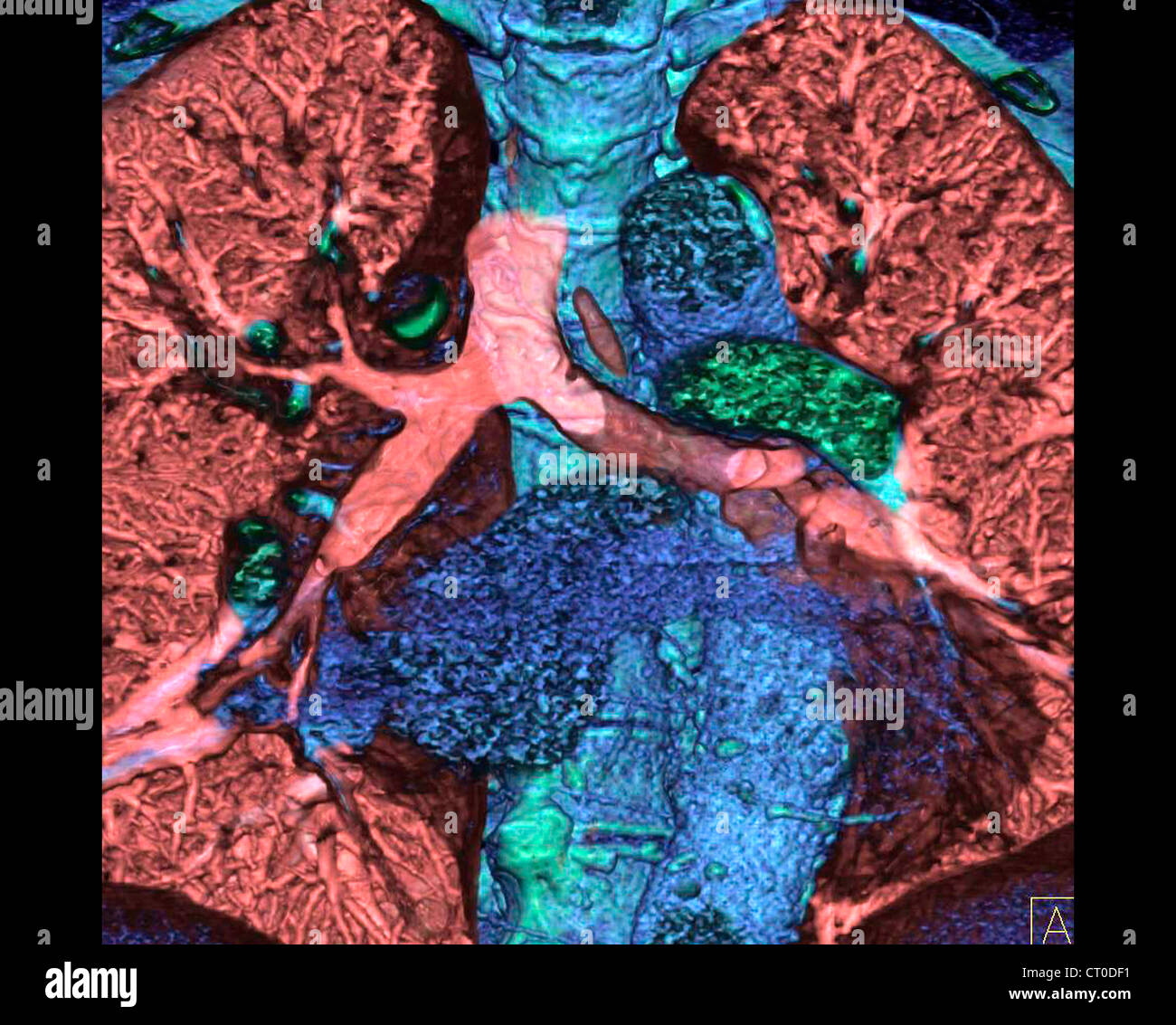 RESPIRATORY TRACT, SCAN Stock Photo - Alamy