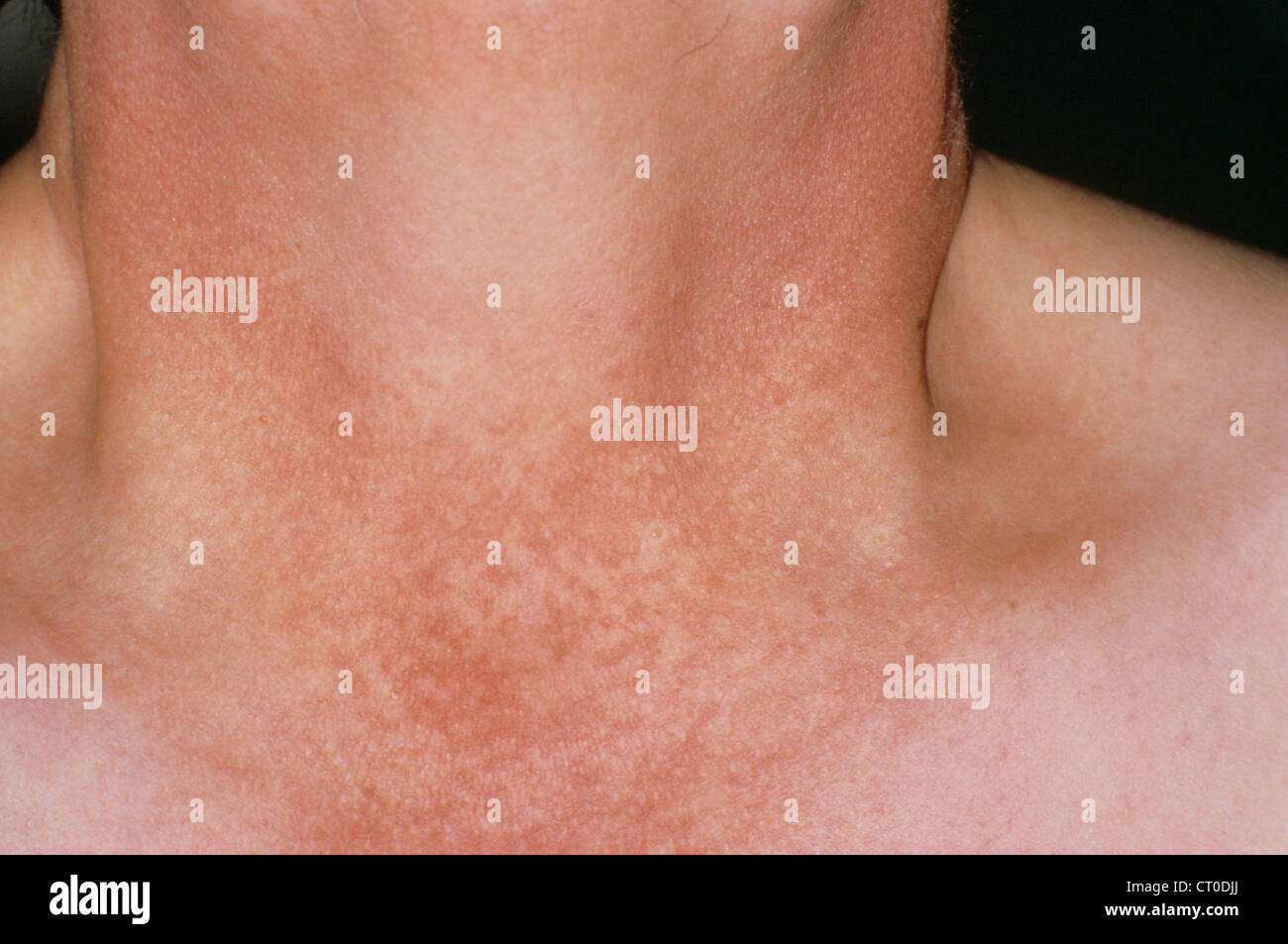 Erythematous rash hi-res stock photography and images - Alamy