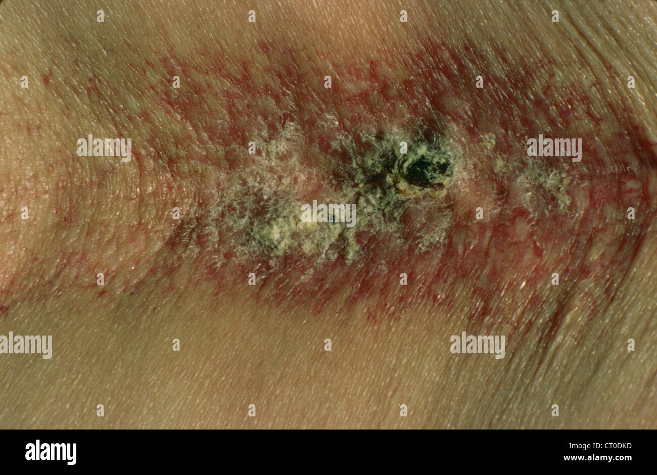 Dermititis hi-res stock photography and images - Alamy