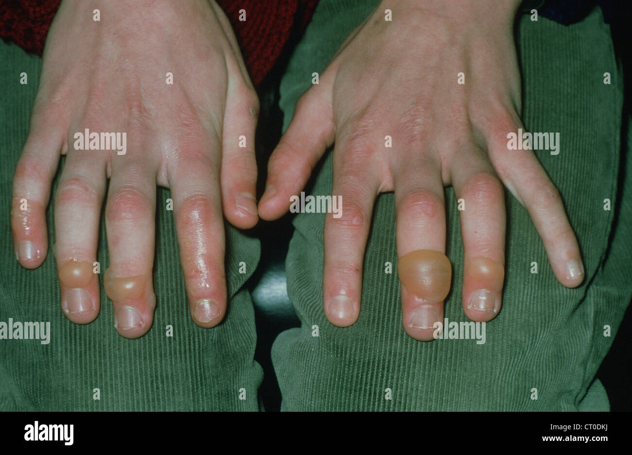 Chilblains hi-res stock photography and images - Alamy