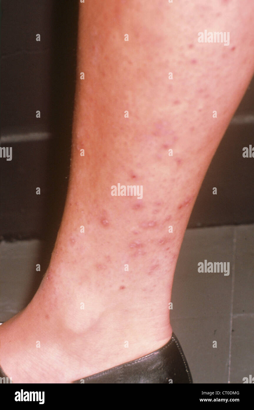 Prurigo hi-res stock photography and images - Alamy