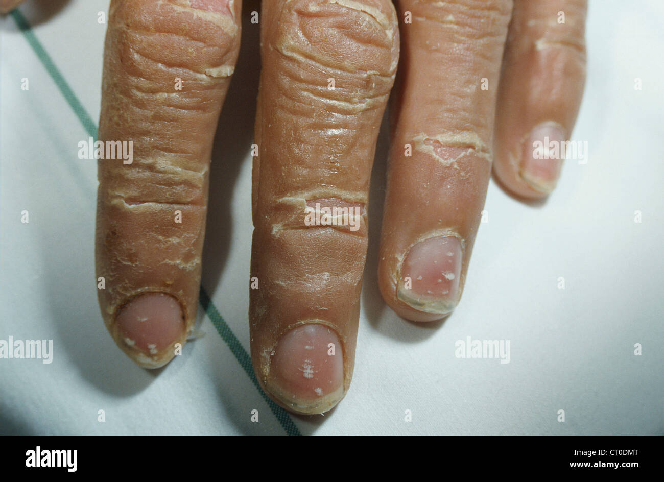 DESQUAMATION OF THE SKIN Stock Photo - Alamy