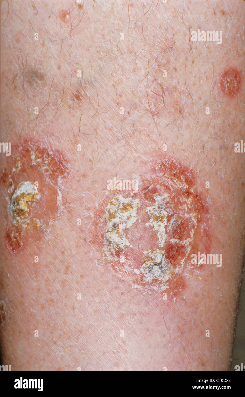 SNEDDON WILKINSON DISEASE Stock Photo - Alamy