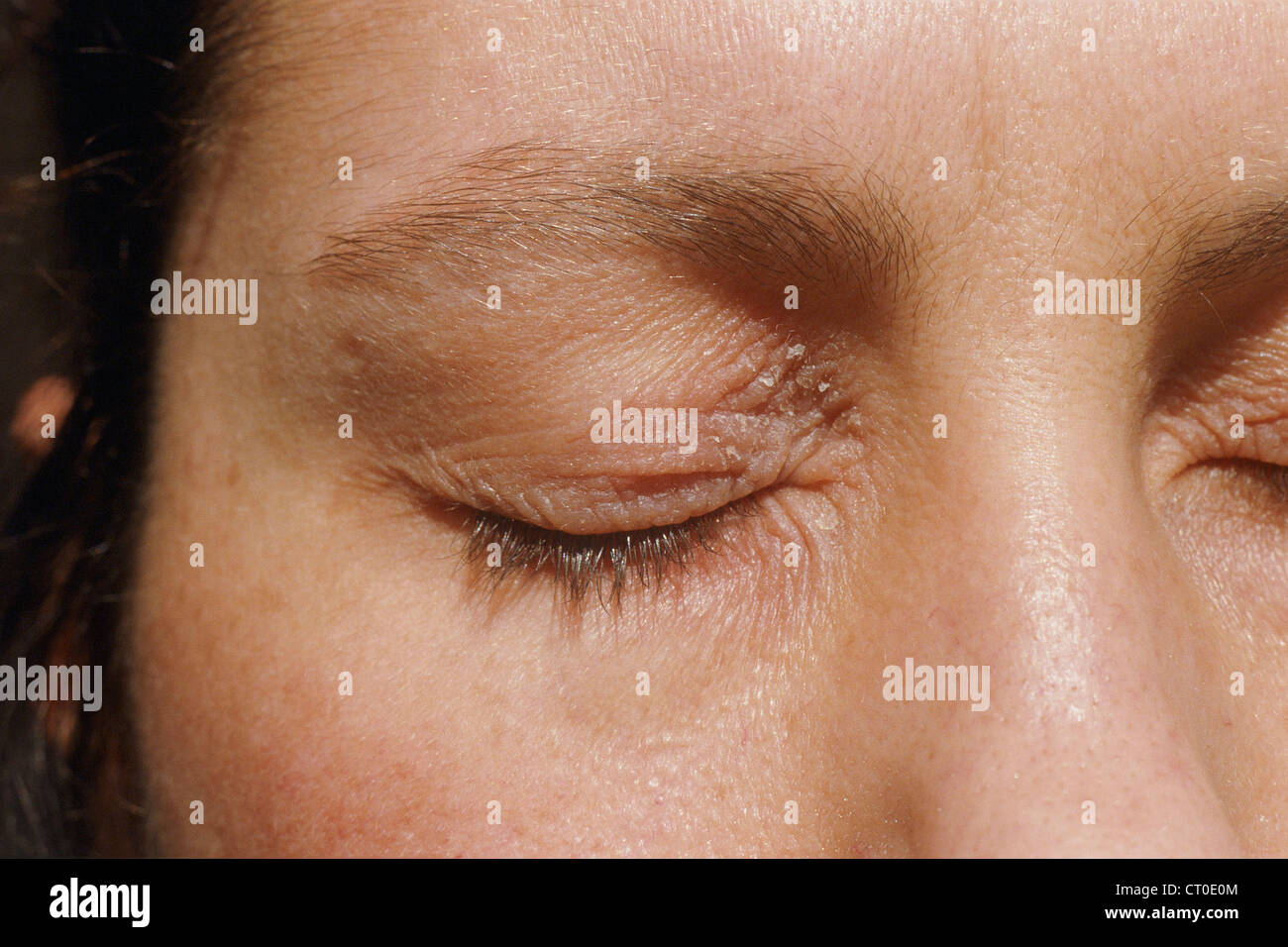 Dyshidrosis hi-res stock photography and images - Alamy