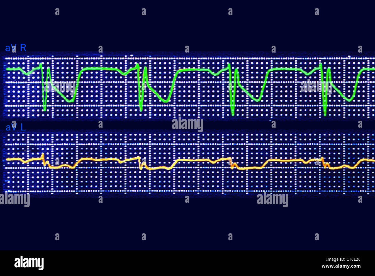 HEART ATTACK, ECG Stock Photo - Alamy