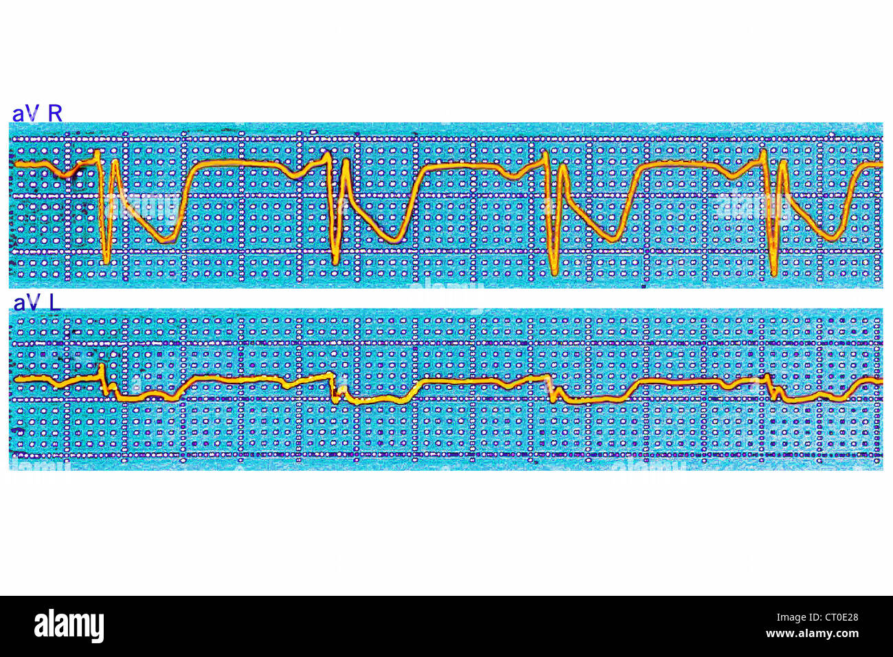 HEART ATTACK, ECG Stock Photo - Alamy
