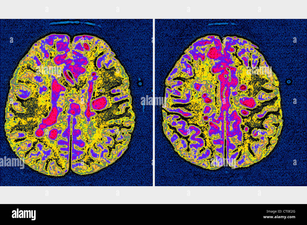 Multiple sclerosis brain hi-res stock photography and images - Alamy