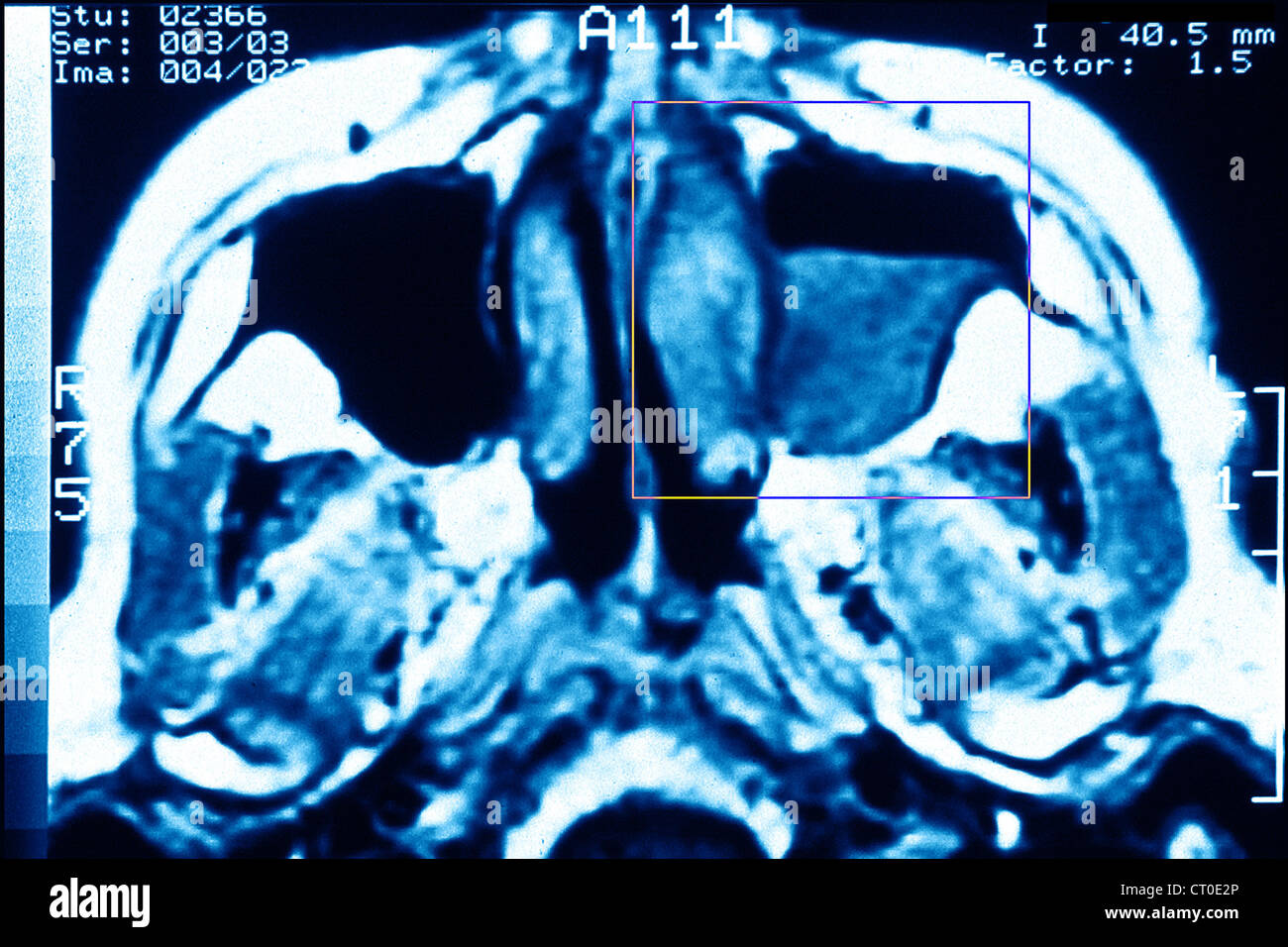 Sem cephalic heads sinus sinuses scientific hi-res stock photography ...