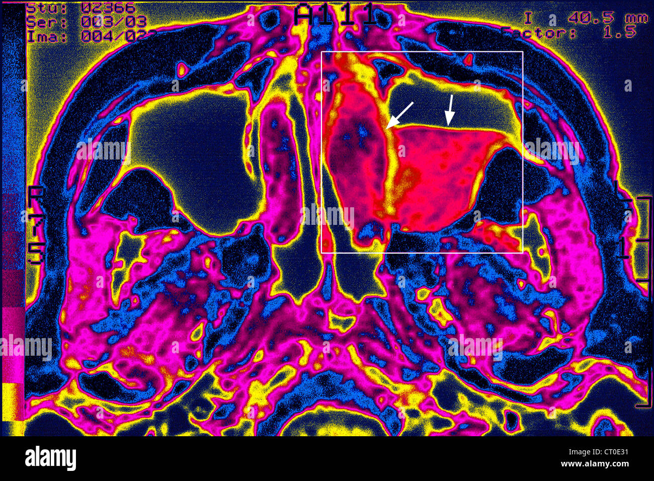 Sem cephalic heads sinus sinuses scientific hi-res stock photography ...