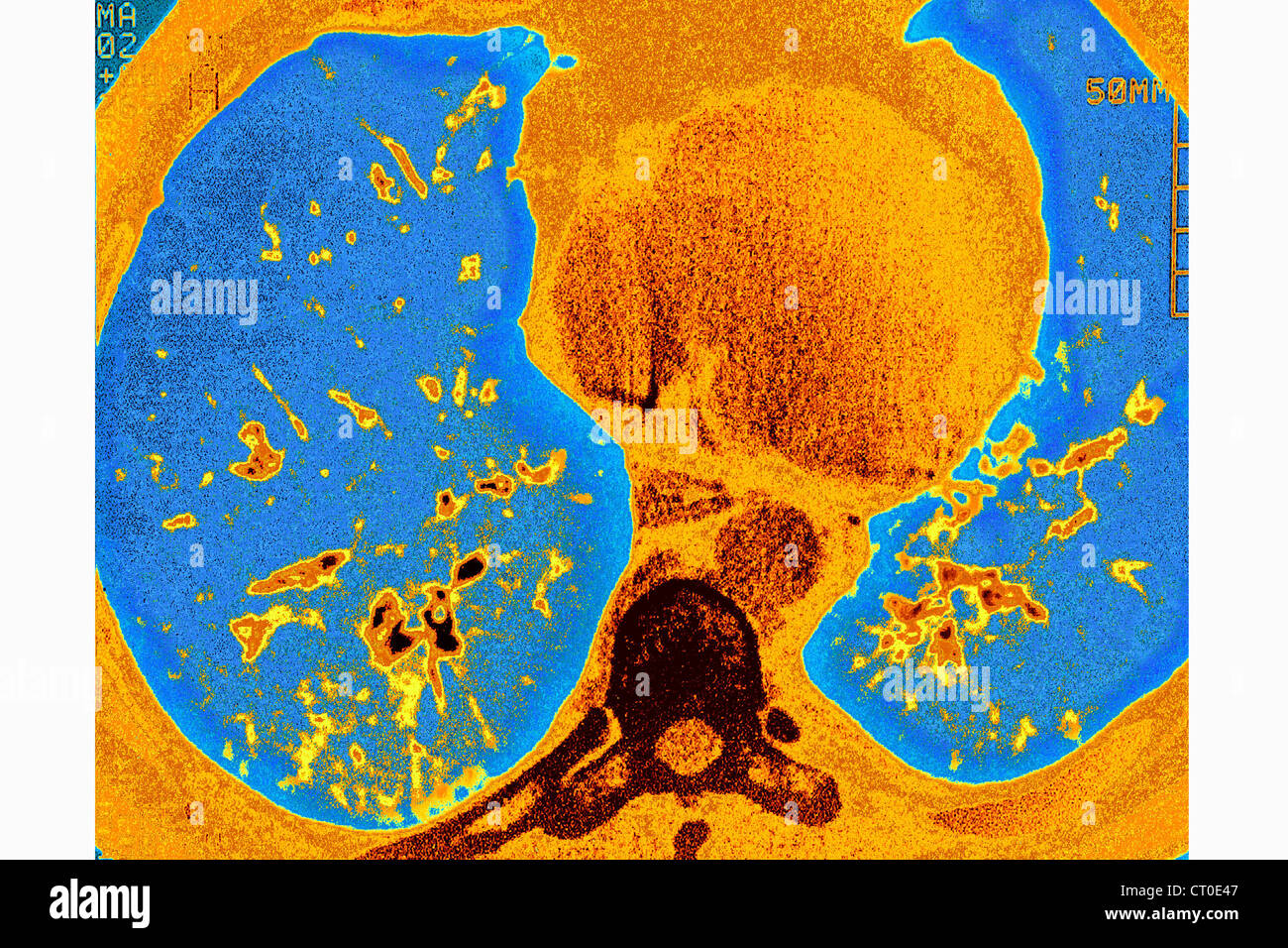 Bronchial Tubes Bronchitis High Resolution Stock Photography and Images ...
