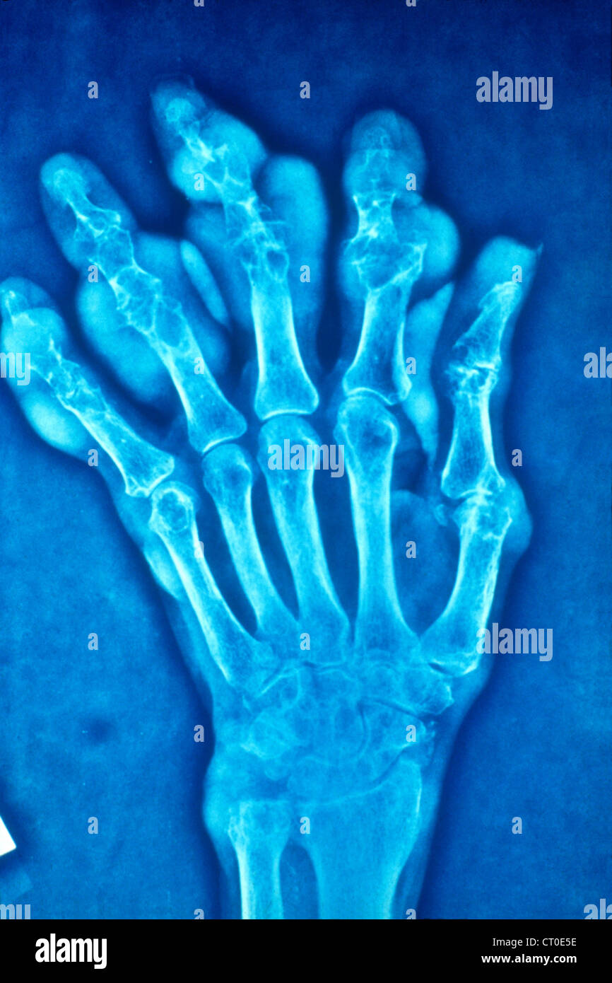 GOUT, X-RAY Stock Photo: 49183610 - Alamy