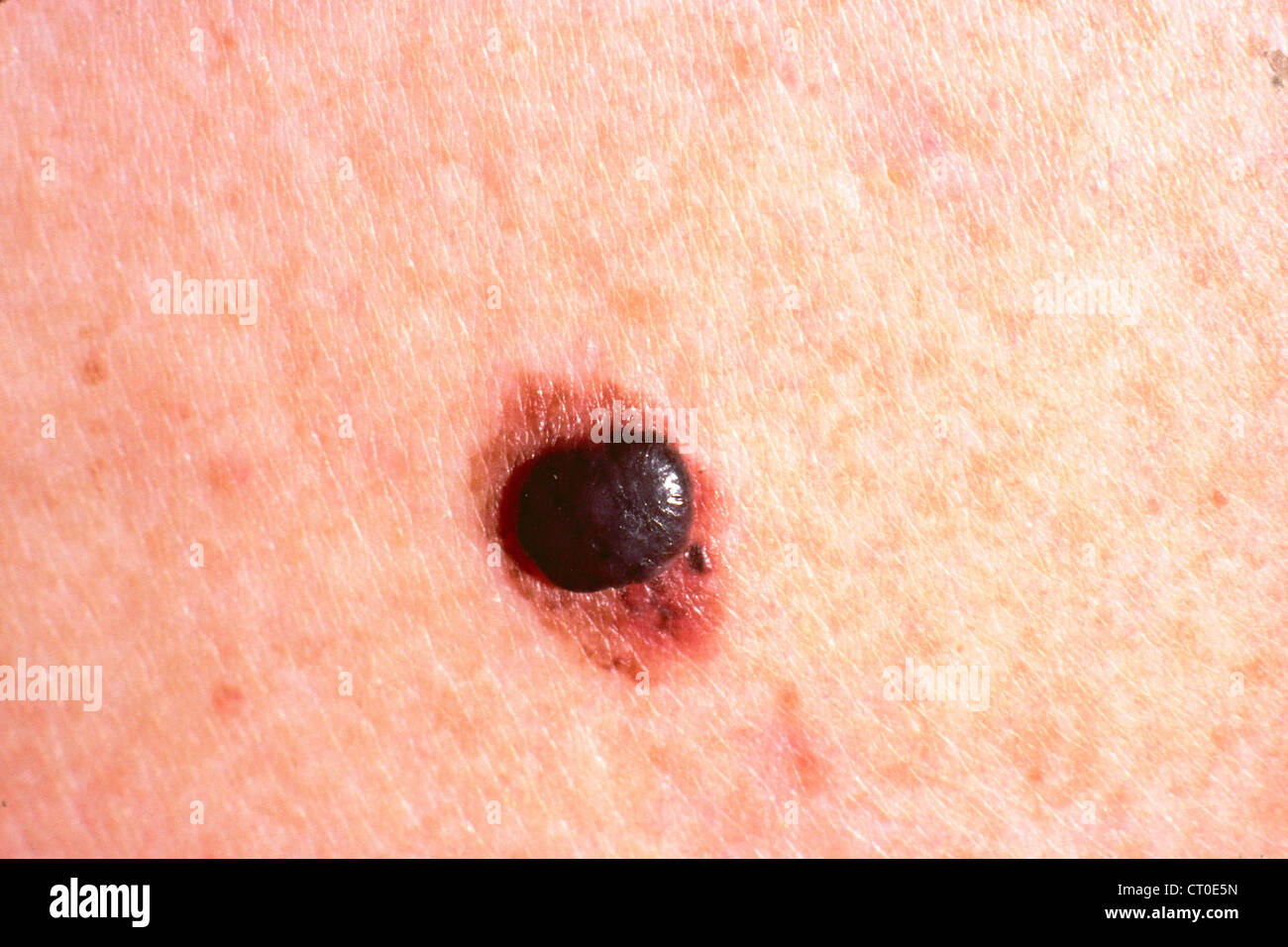 Malignant melanomas hi-res stock photography and images - Alamy