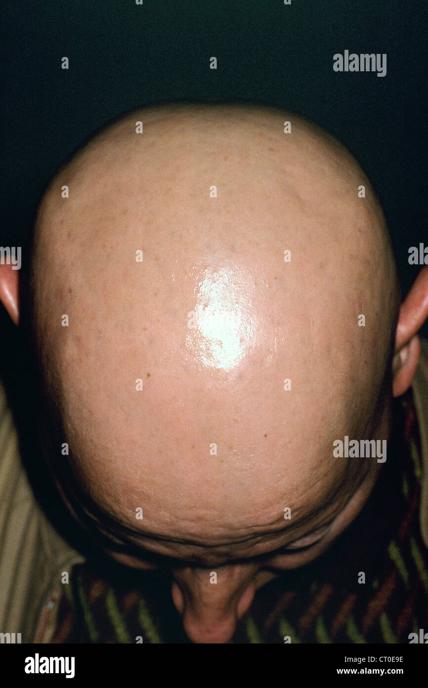 Desquamation hi-res stock photography and images - Alamy