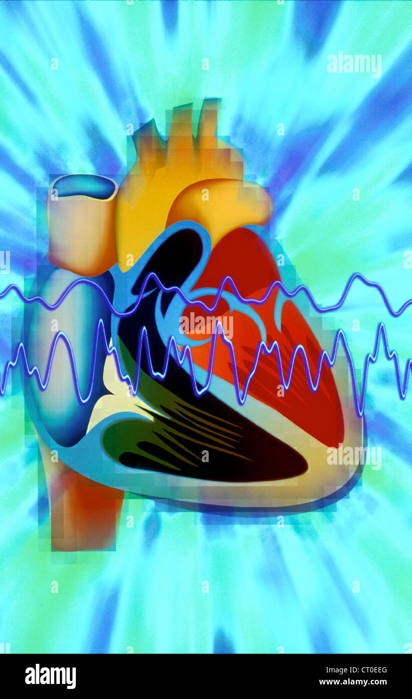 HEART ATTACK, DRAWING Stock Photo - Alamy
