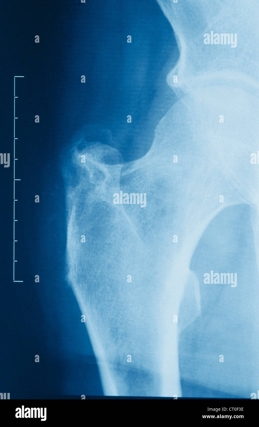 TUBERCULOSIS IN THE BONES, X-RAY Stock Photo - Alamy