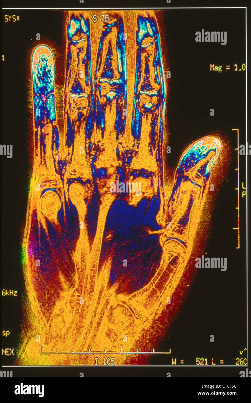 Mri magnetic resonance imaging hands hi-res stock photography and ...