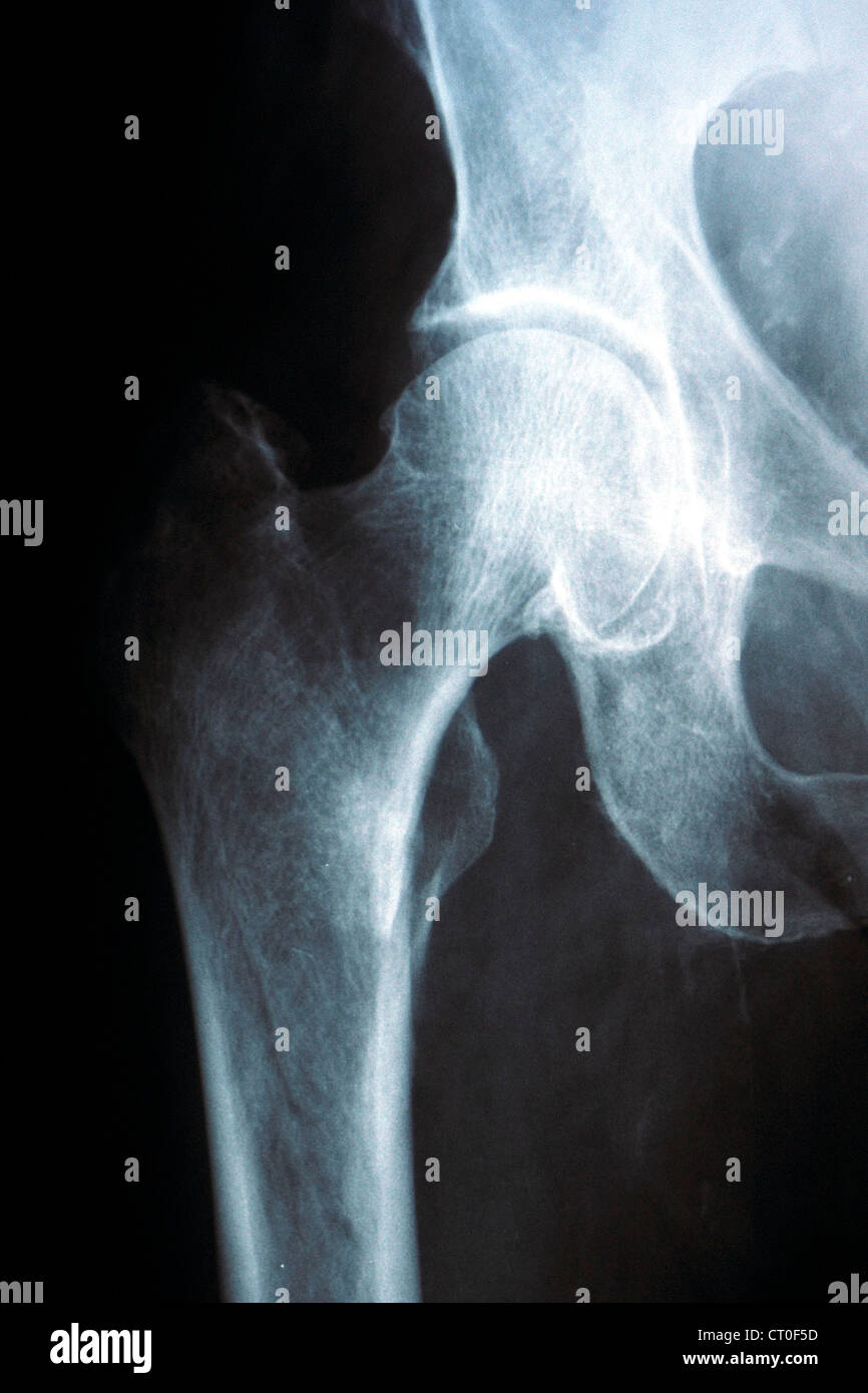 FRACTURED HIP, X-RAY Stock Photo - Alamy