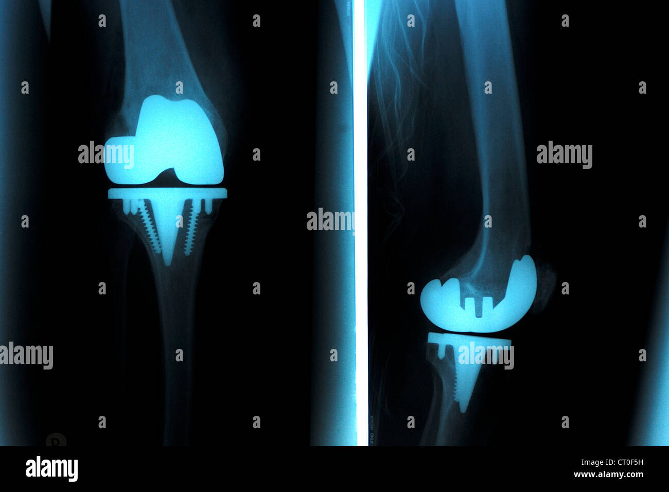 KNEE PROSTHESIS, X-RAY Stock Photo - Alamy