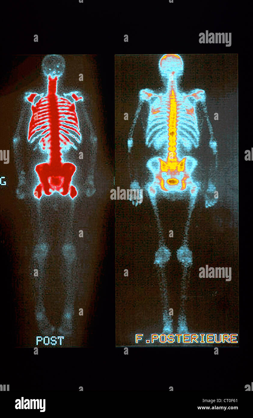 Bone scintigraphy hi-res stock photography and images - Alamy
