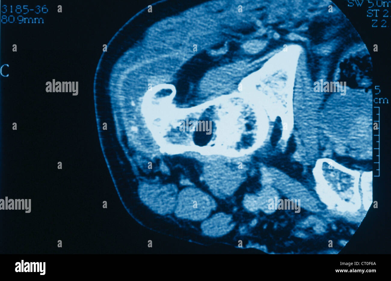 TUBERCULOSIS IN THE BONES, SCAN Stock Photo - Alamy