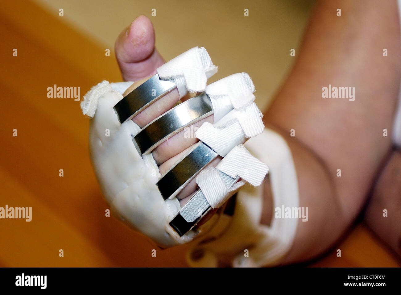 Orthopedic splints hi-res stock photography and images - Alamy