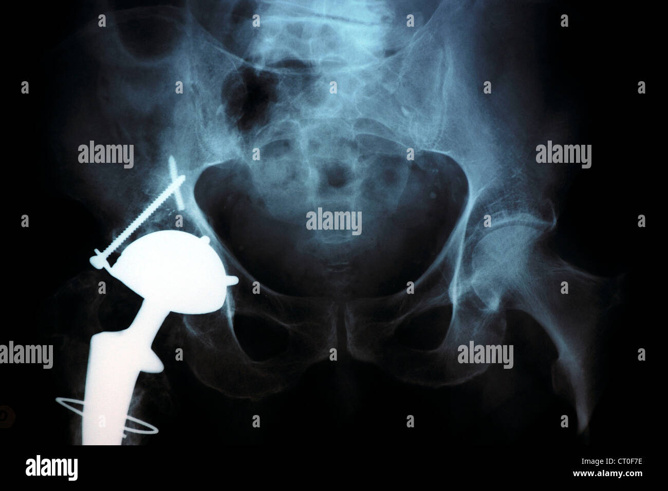 HIP PROSTHESIS, X-RAY Stock Photo - Alamy