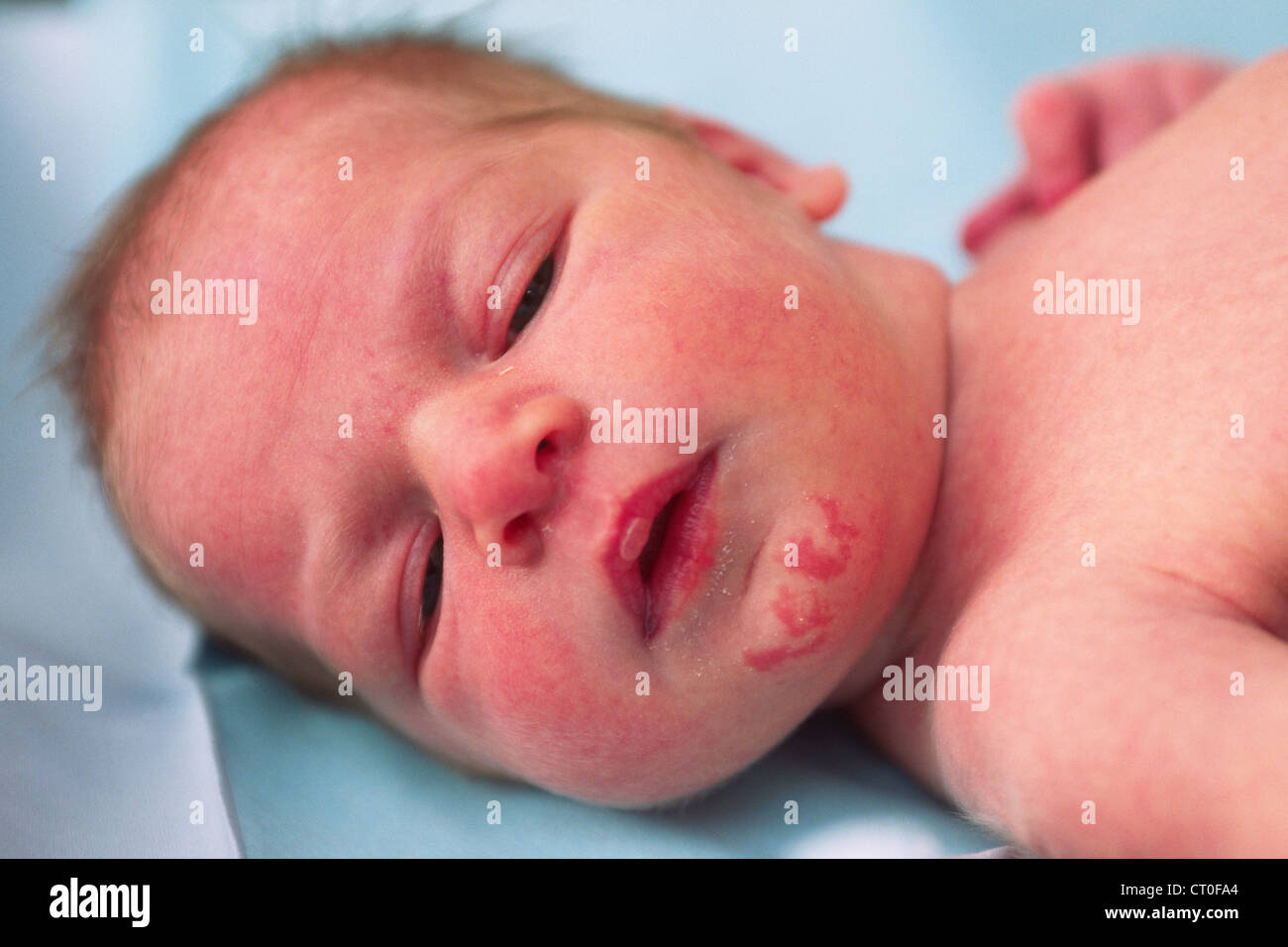 Erythematous rash hi-res stock photography and images - Alamy