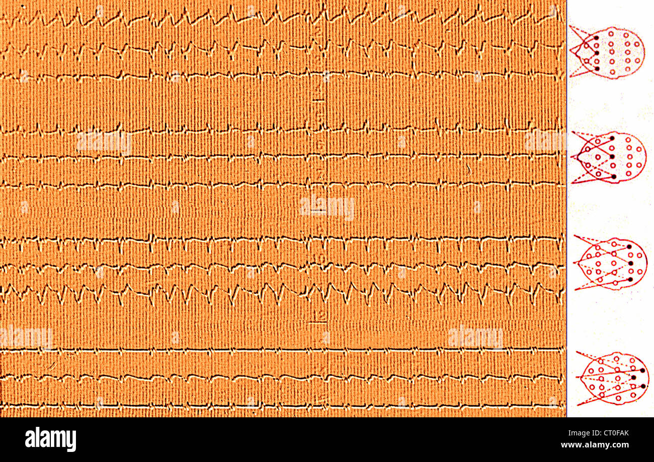 Eeg Test High Resolution Stock Photography and Images - Alamy