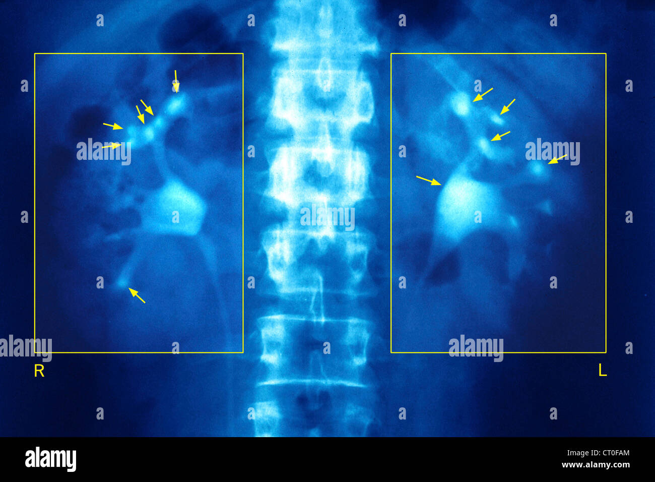 RENAL LITHIASIS, X-RAY Stock Photo - Alamy