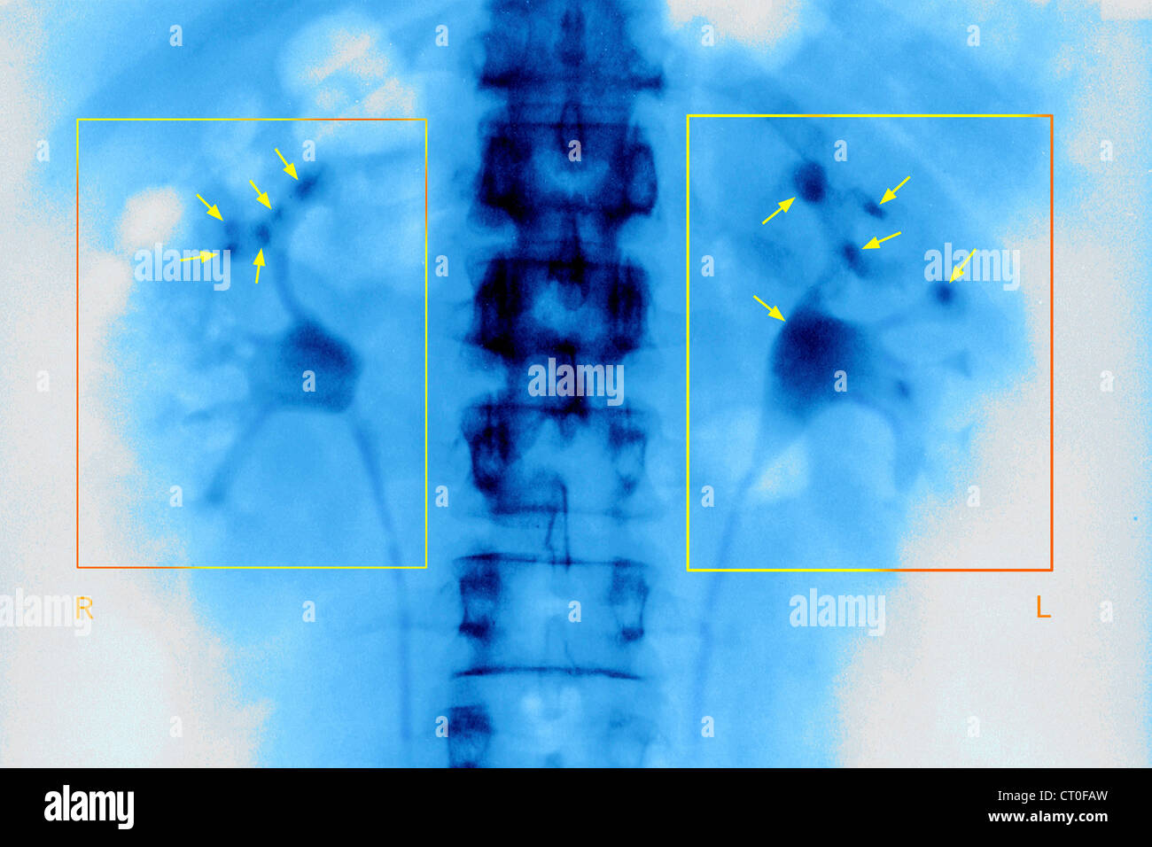 RENAL LITHIASIS, X-RAY Stock Photo - Alamy