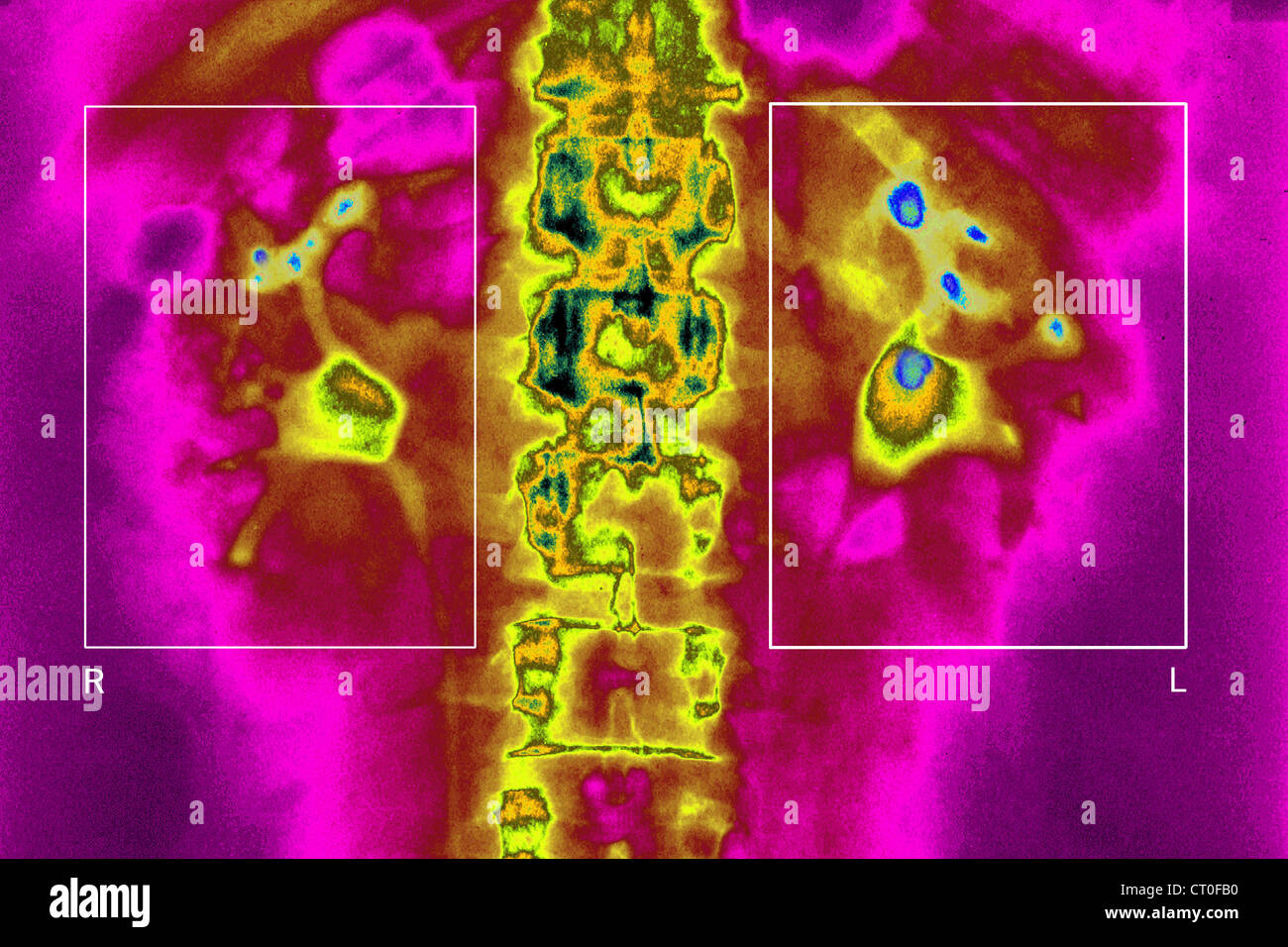 RENAL LITHIASIS, X-RAY Stock Photo - Alamy
